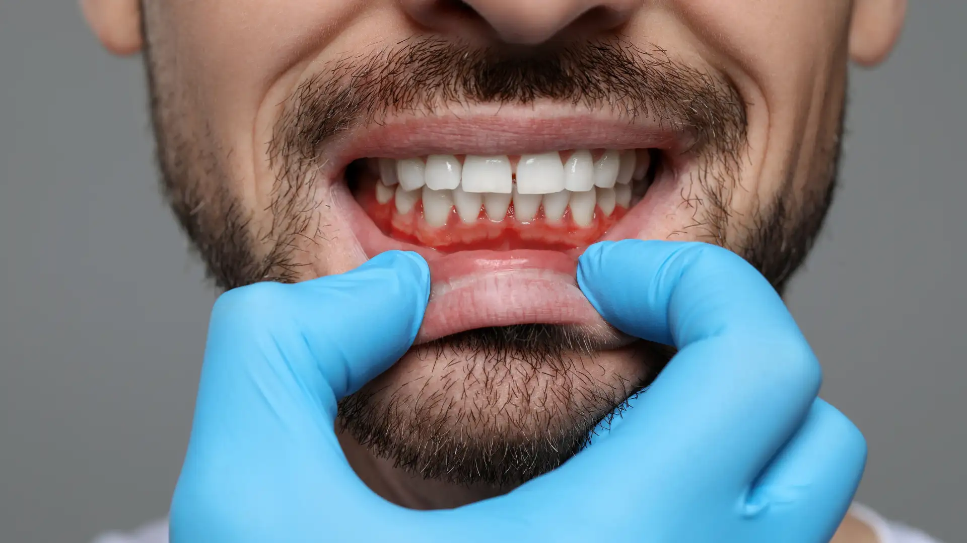 Can You Reverse Gingivitis? Early Treatment and Prevention | Blog